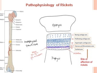 Clinical approach to rickets with special reference to renal rickets ...