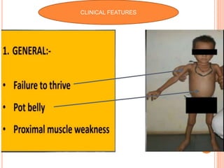Clinical approach to rickets with special reference to renal rickets ...