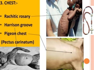 Clinical approach to rickets with special reference to renal rickets ...