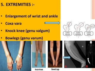 Clinical approach to rickets with special reference to renal rickets ...