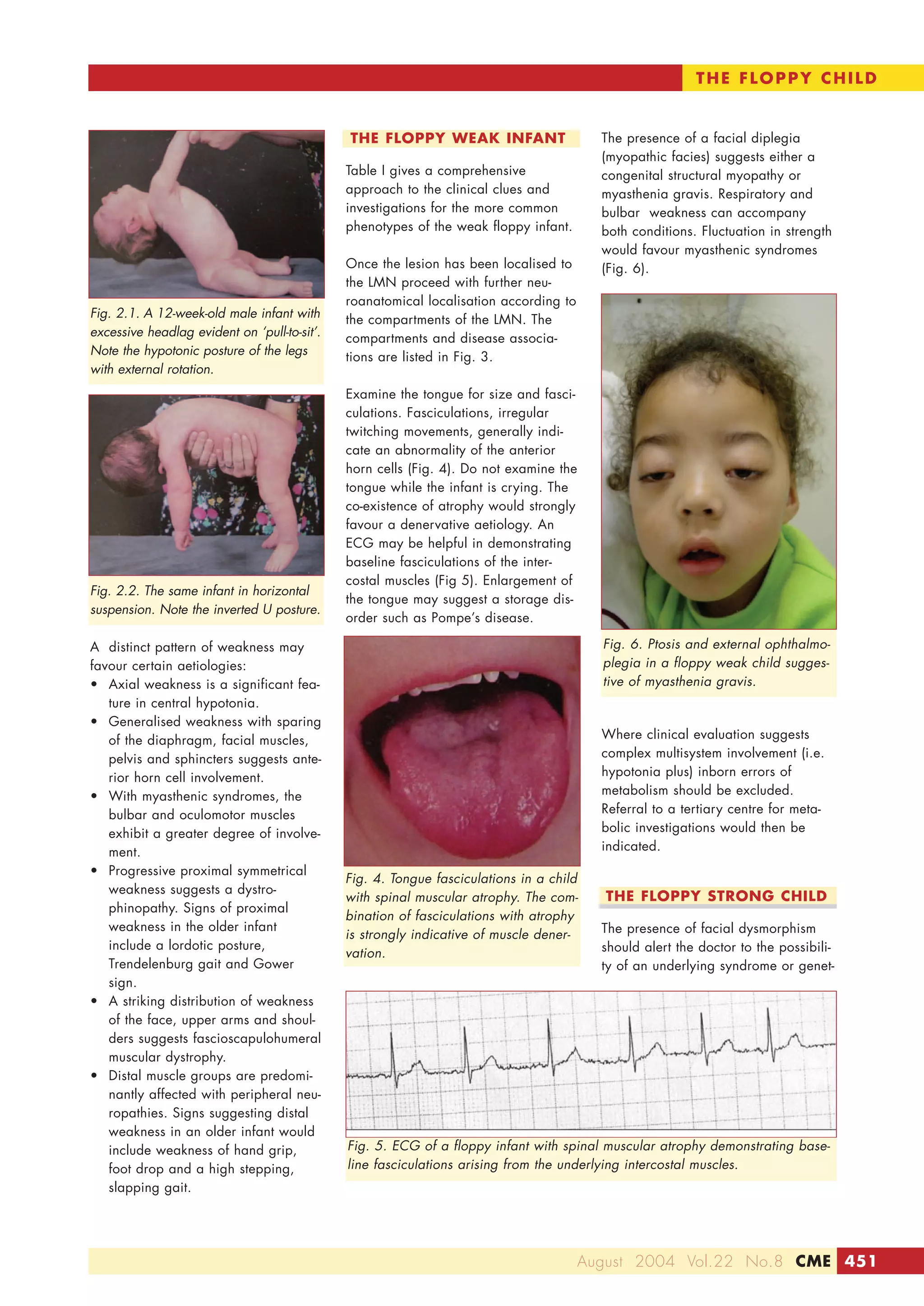 Clinical approach to the floppy child | PDF