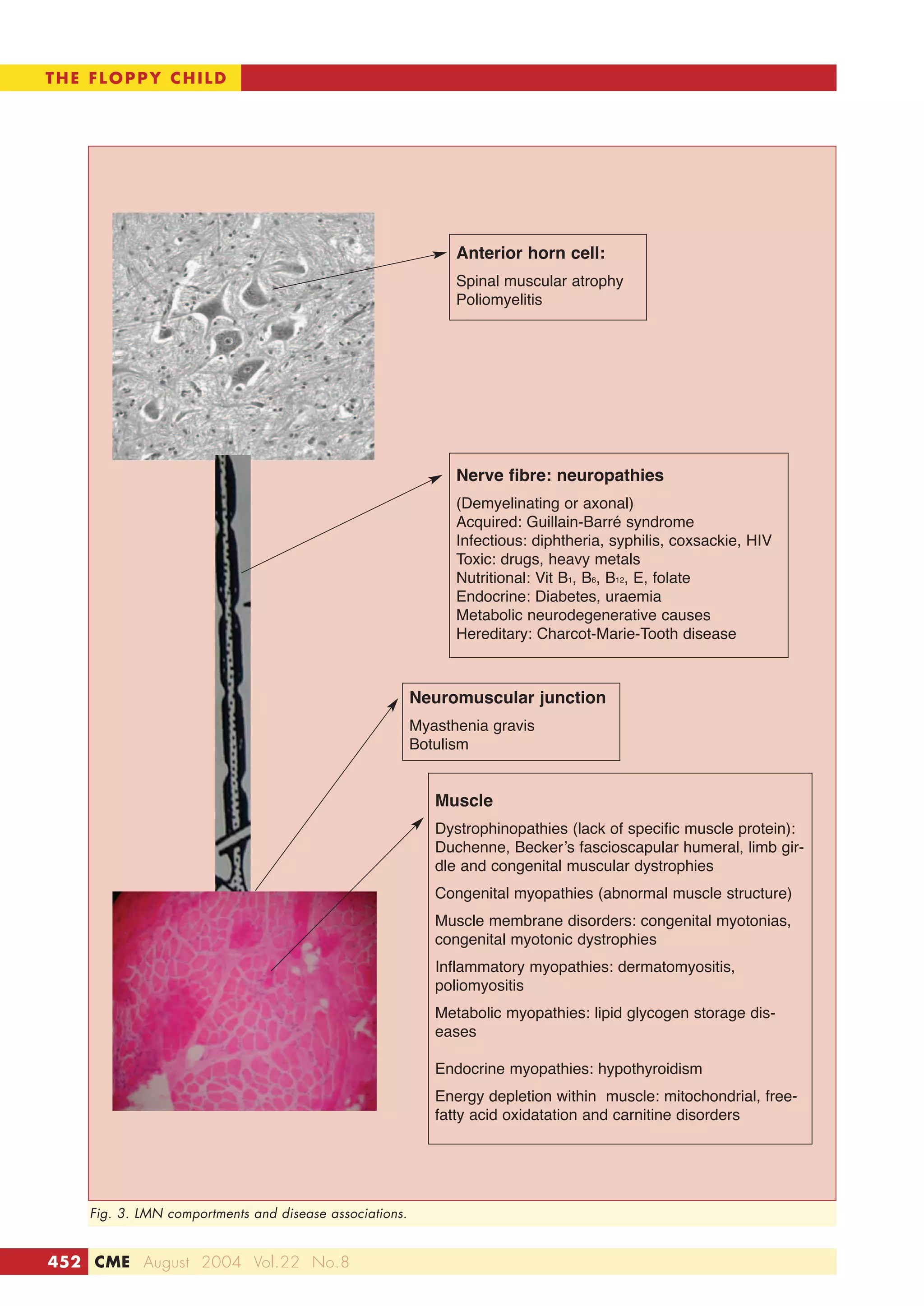 Clinical approach to the floppy child | PDF