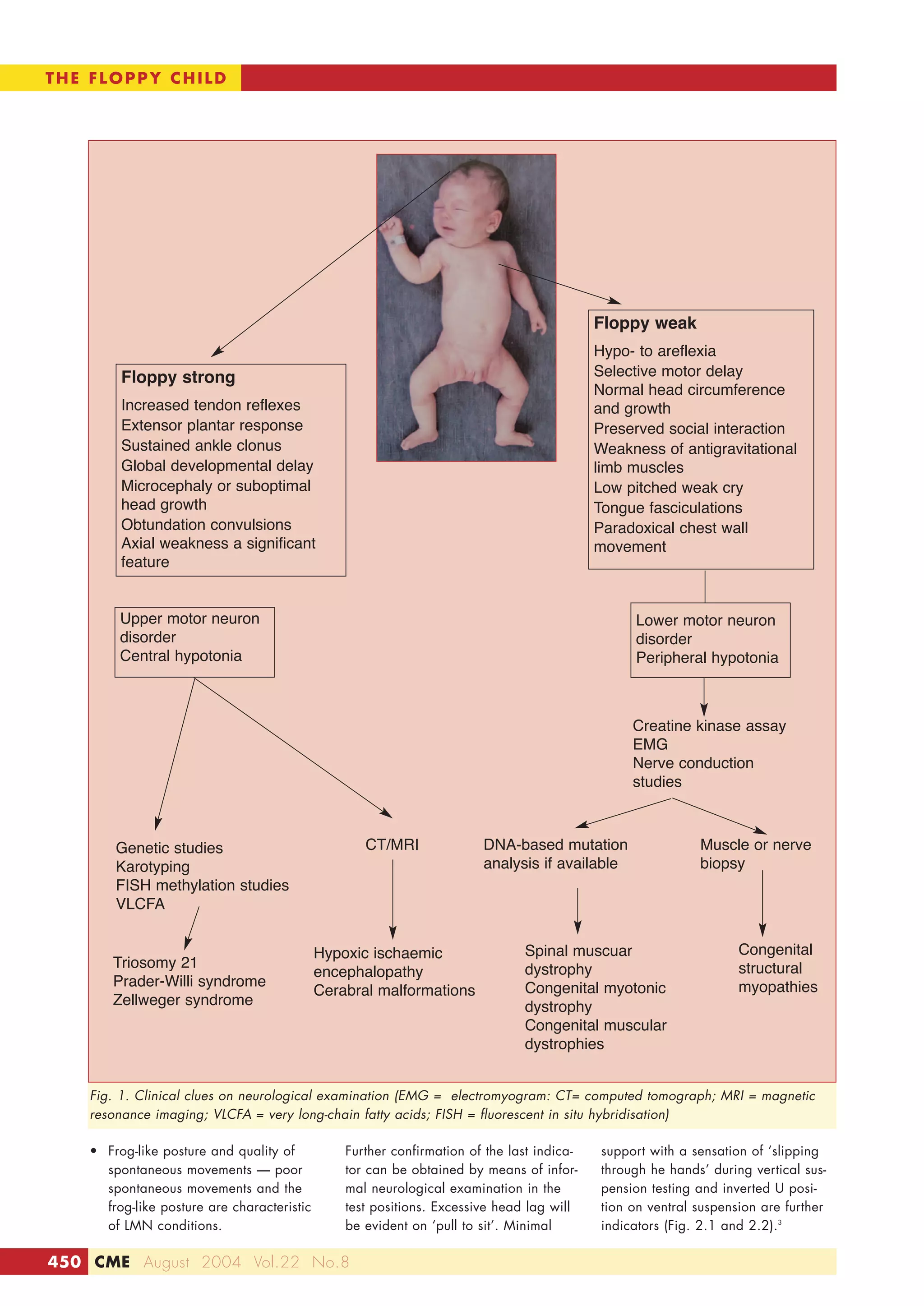 Clinical approach to the floppy child | PDF