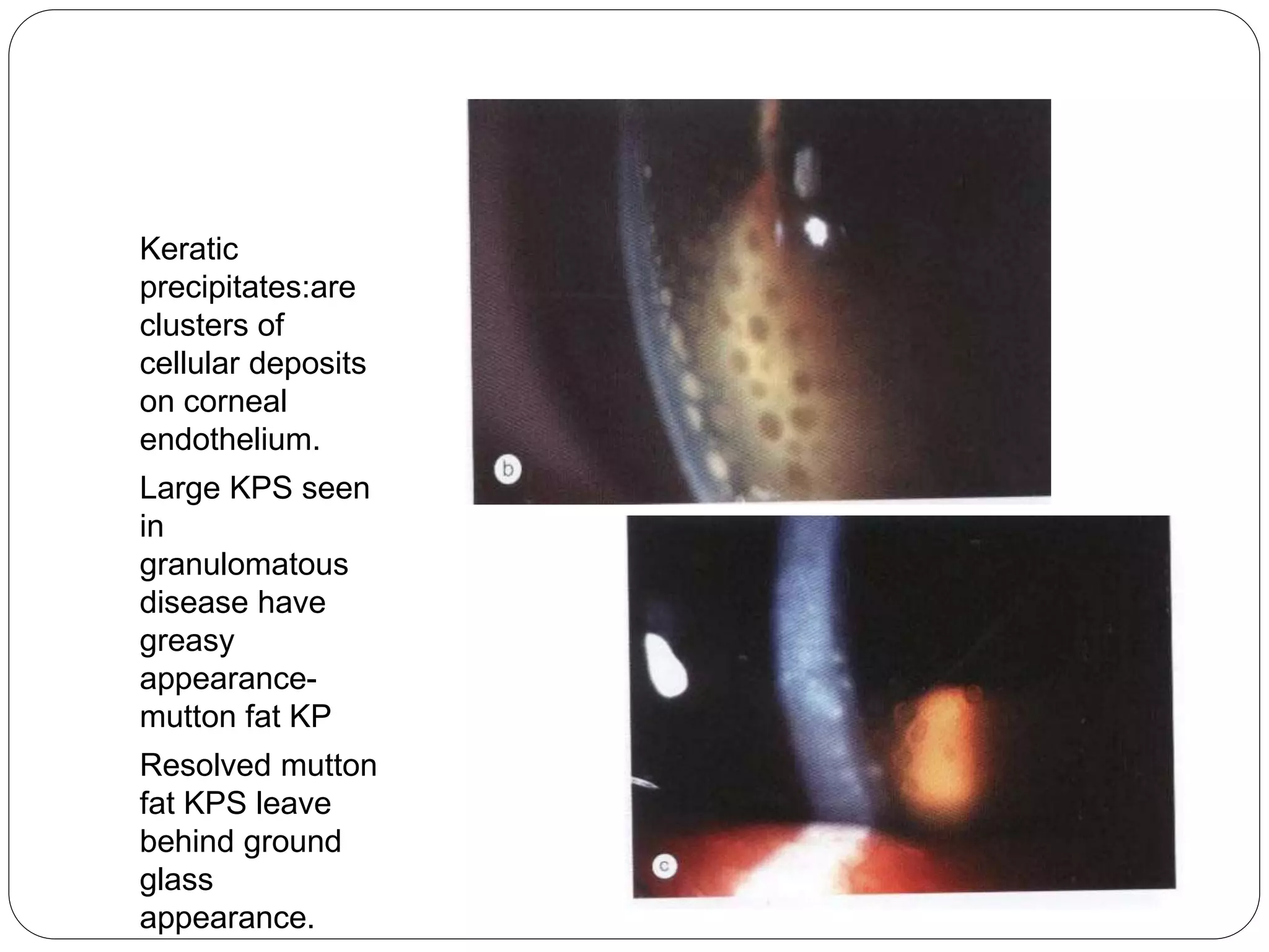 Clinical approach to uveitis | PPTX