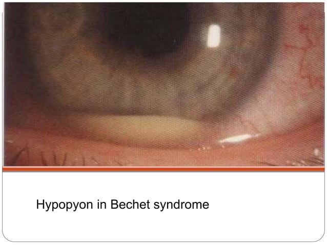 Clinical approach to uveitis | PPTX