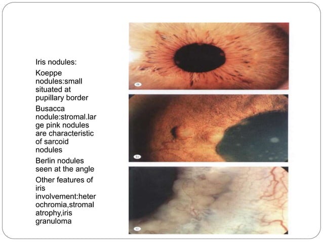 Clinical approach to uveitis | PPTX