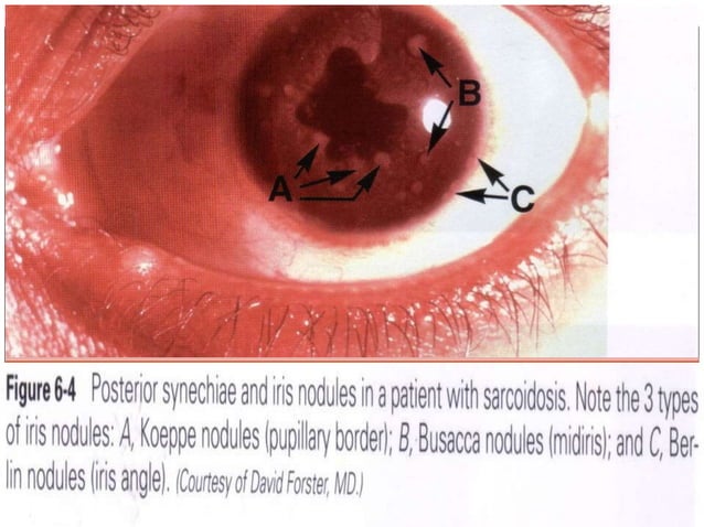 Clinical approach to uveitis | PPTX
