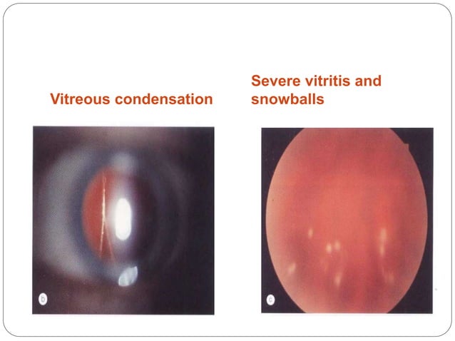 Clinical approach to uveitis | PPTX