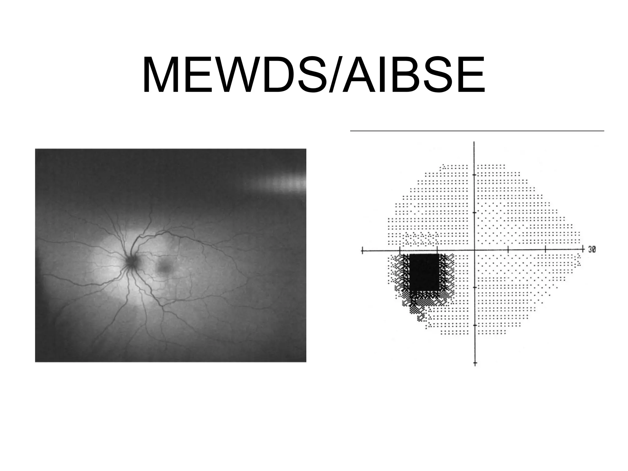 Clinical approach to acute vision loss | PPTX