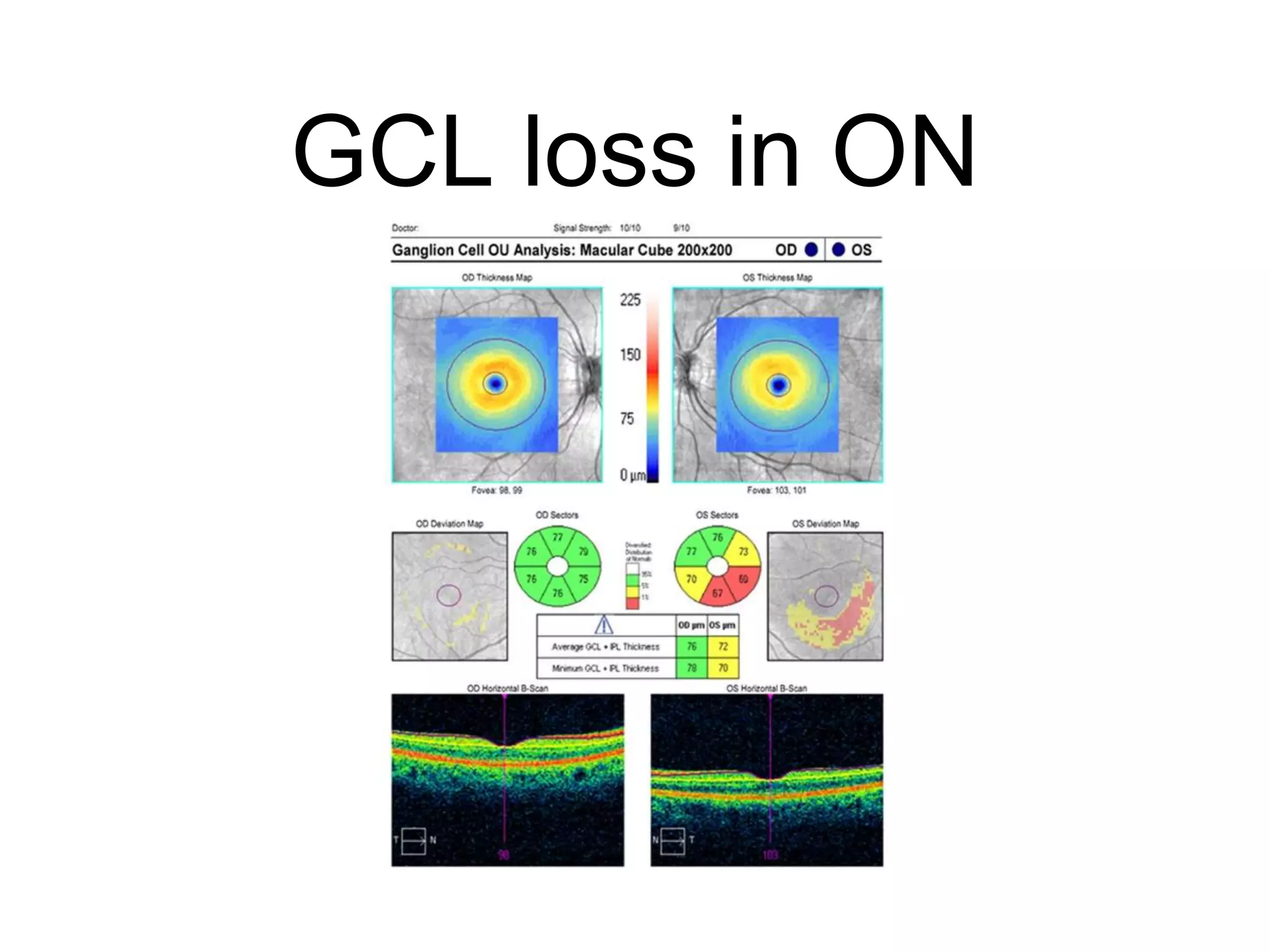 Clinical approach to acute vision loss | PPTX