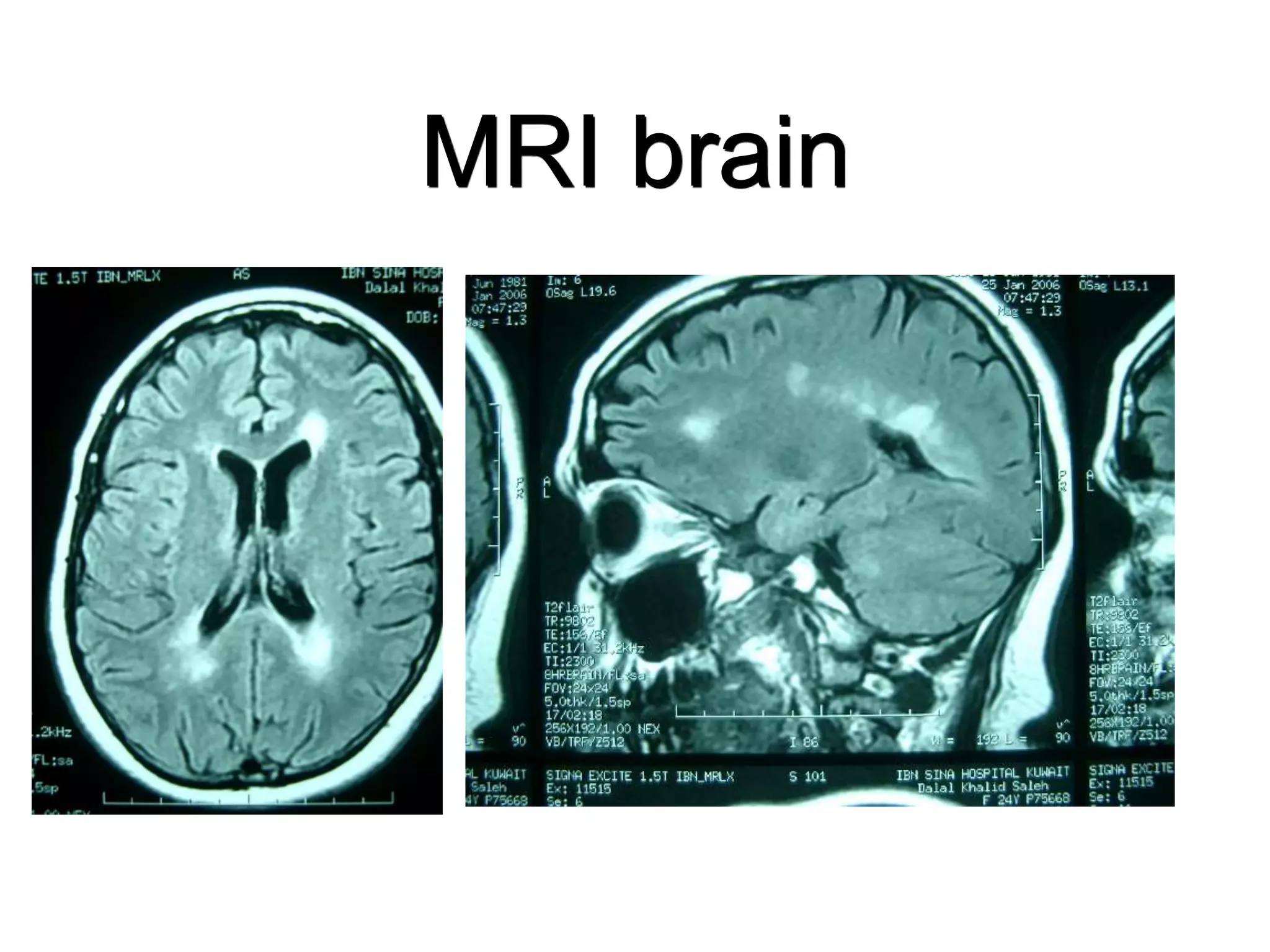 Clinical approach to acute vision loss | PPTX