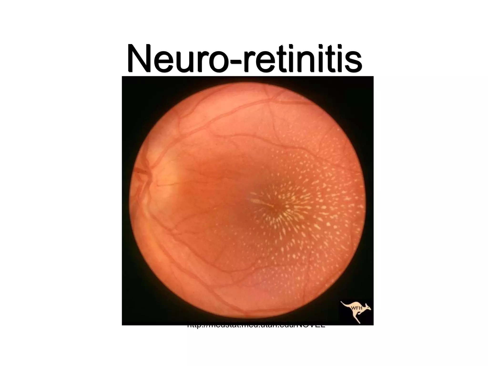 Clinical approach to acute vision loss | PPTX
