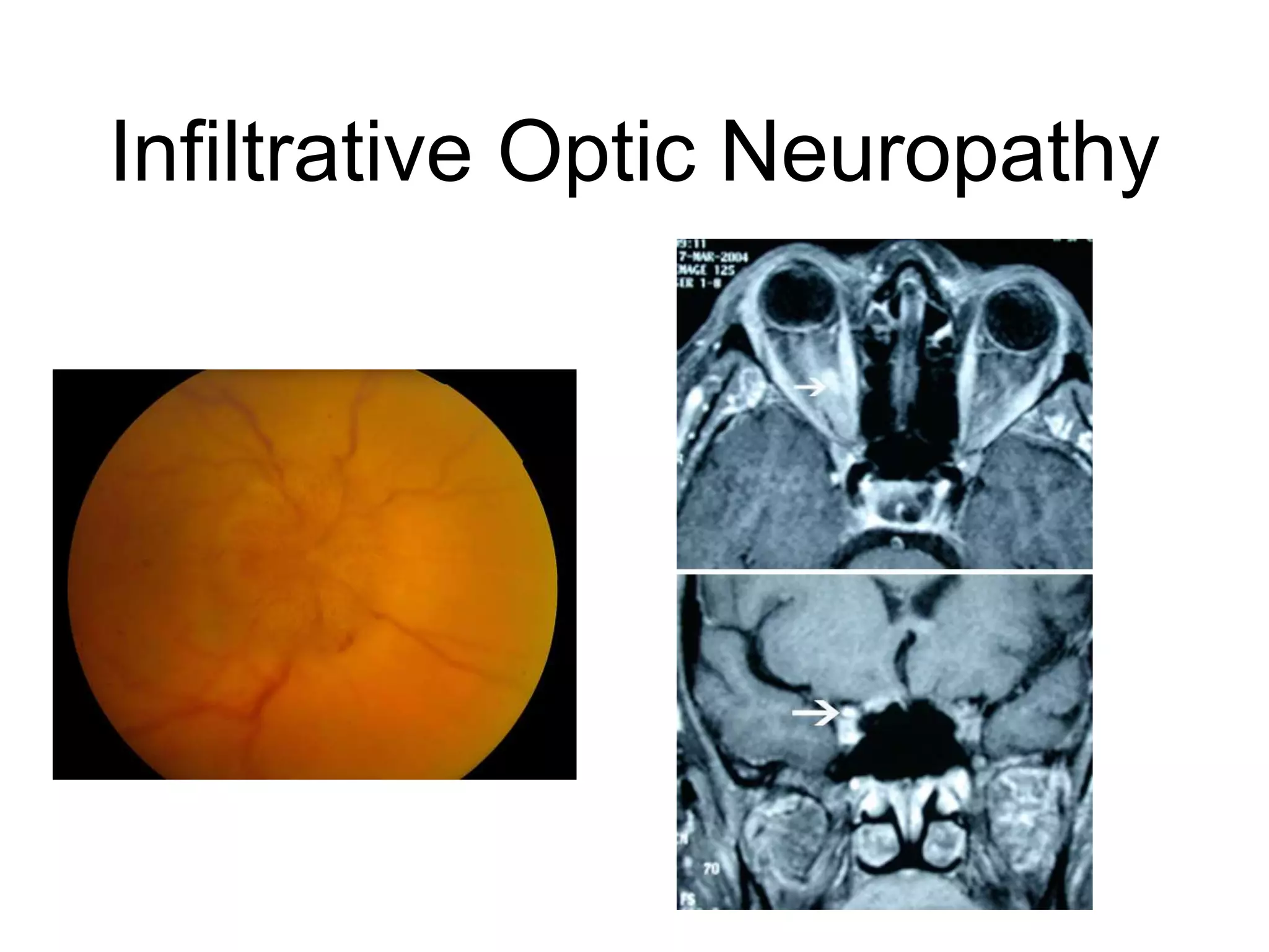Clinical approach to acute vision loss | PPTX