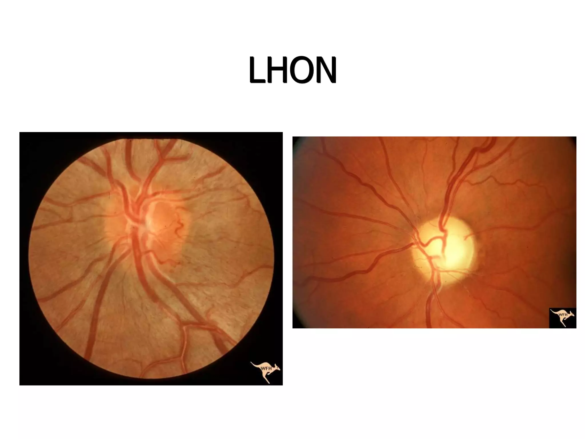 Clinical approach to acute vision loss | PPTX
