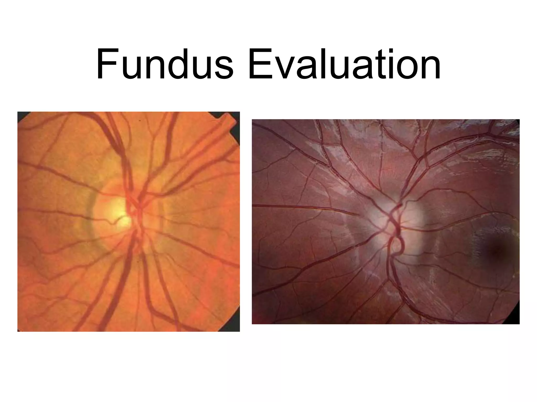 Clinical approach to acute vision loss | PPTX