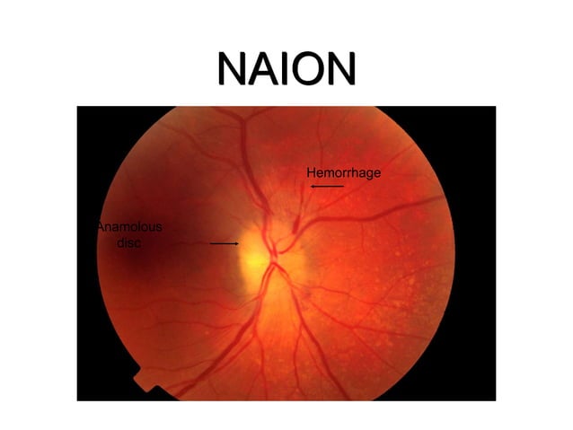 Clinical approach to acute vision loss | PPTX