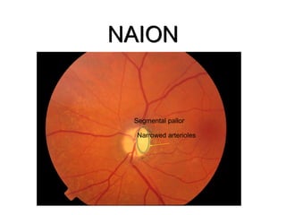 Clinical approach to acute vision loss | PPTX