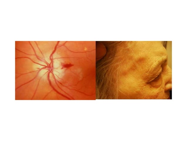 Clinical approach to acute vision loss | PPTX