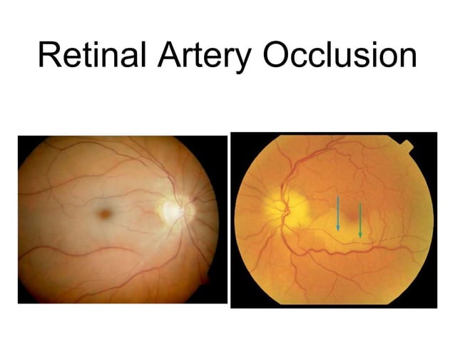 Clinical approach to acute vision loss | PPTX