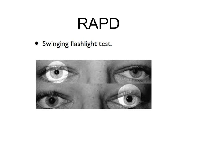 Clinical approach to acute vision loss | PPTX