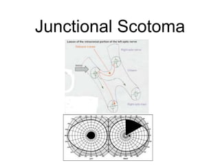 Clinical approach to acute vision loss | PPTX