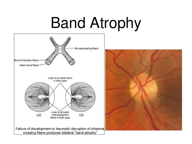 Clinical approach to acute vision loss