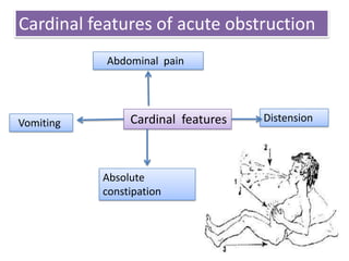 Clinical aspect of intestinal obstruction Ritasman Baisya Medical ...