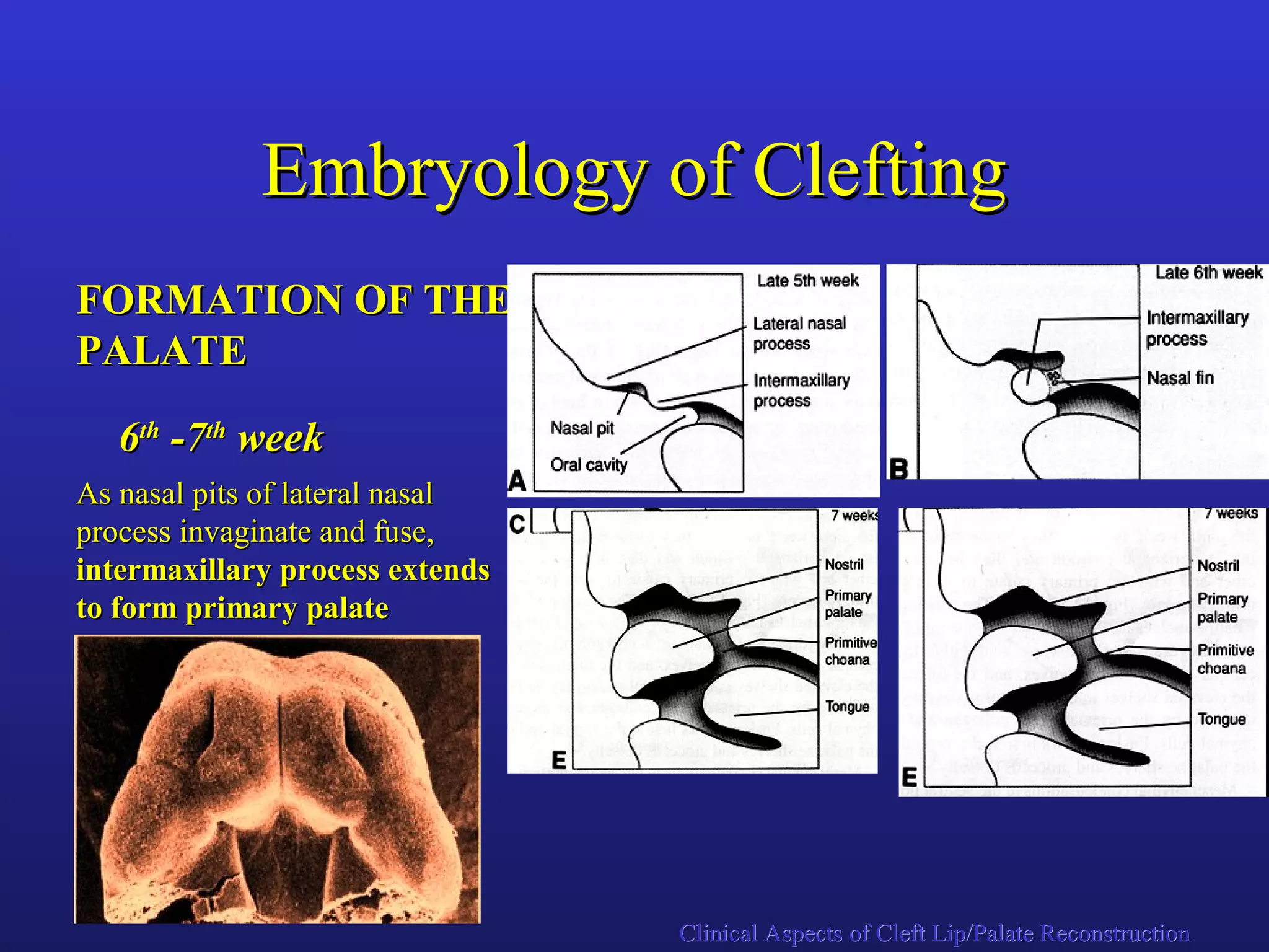 Clinical aspects of cleft lip & palate reconstruction | PPT