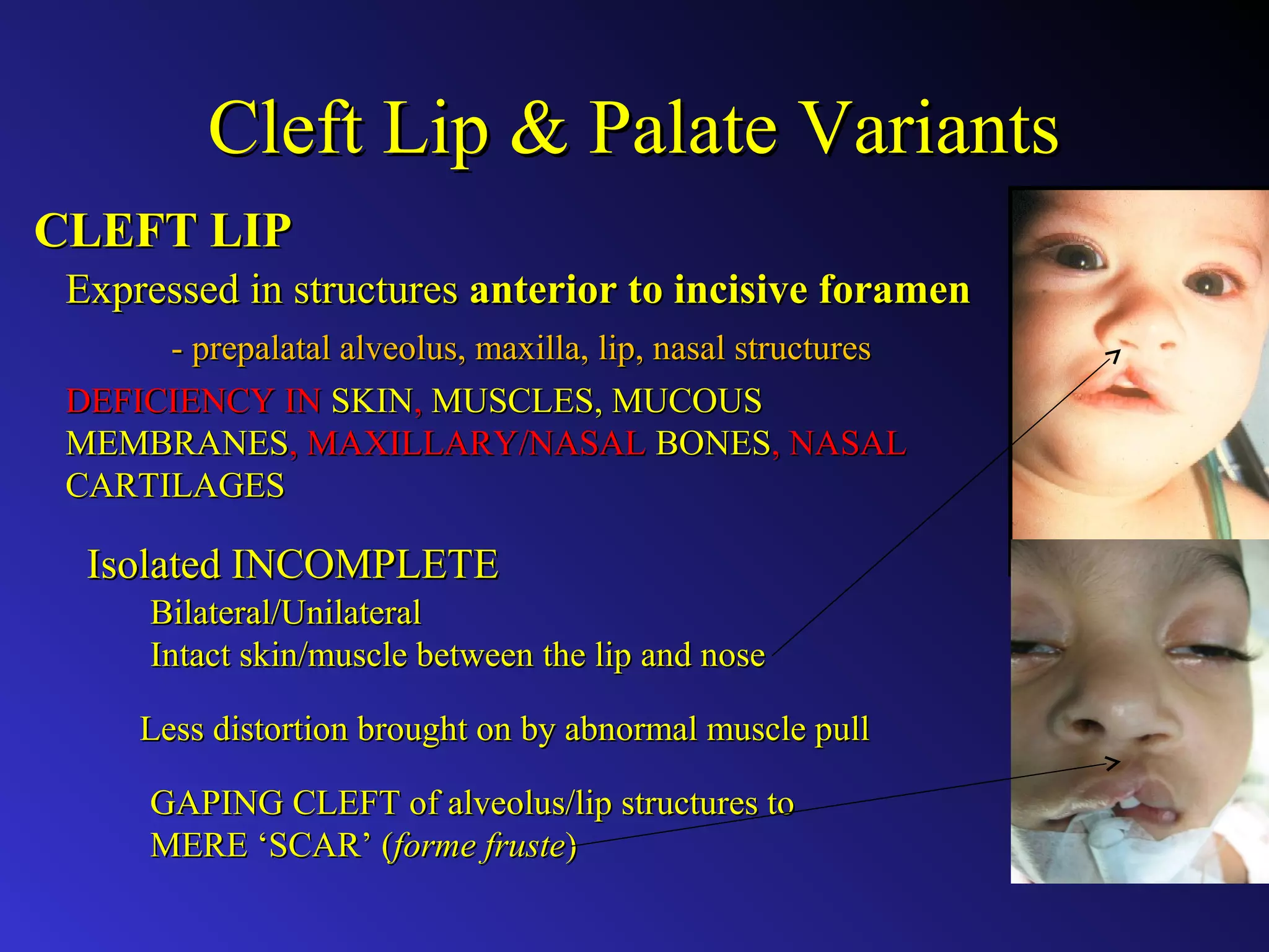 Clinical aspects of cleft lip & palate reconstruction | PPT