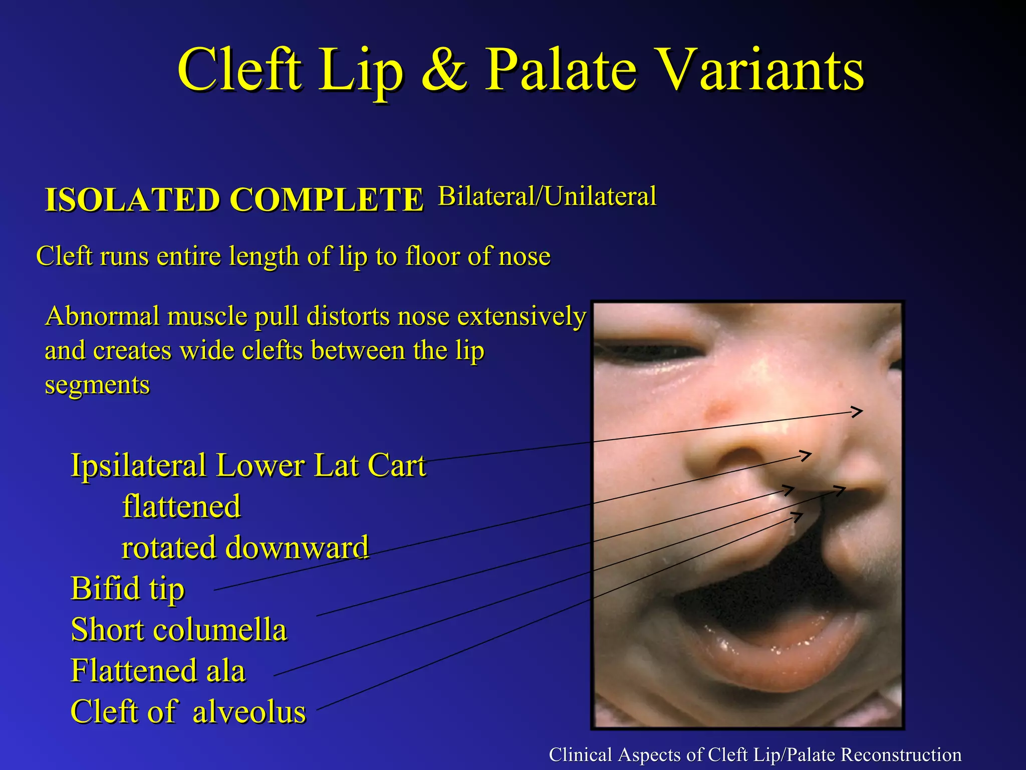Clinical aspects of cleft lip & palate reconstruction | PPT