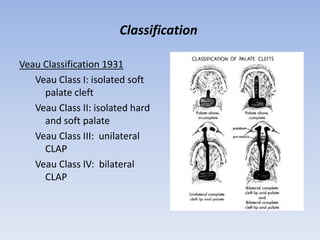 Clinical aspects of cleft palate repair | PPTX