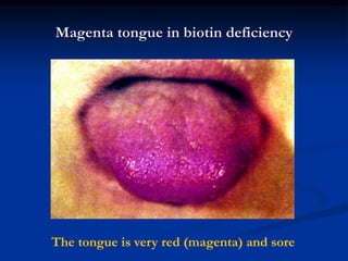 Biotin Deficient Facies