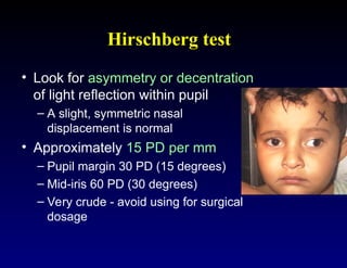 Clinical Assessment of Strabismus and evaluation technique | PPT