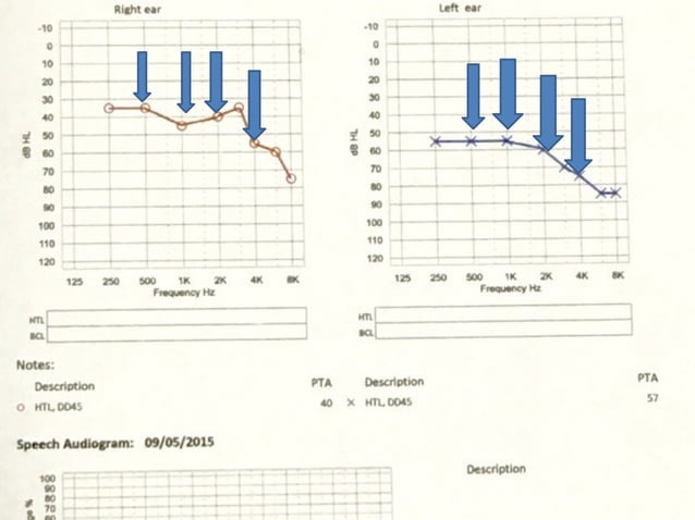 Clinical Audiology.presentation ear audiogram | PPT