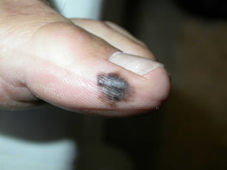 Clinical case. pigmented lesion on the toe | PPT
