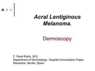 Acral lentiginous melanoma | PPT