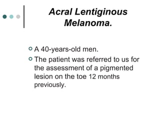 Acral lentiginous melanoma | PPT