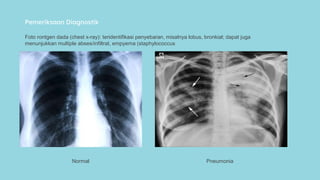 Askep Pneumonia.pptx