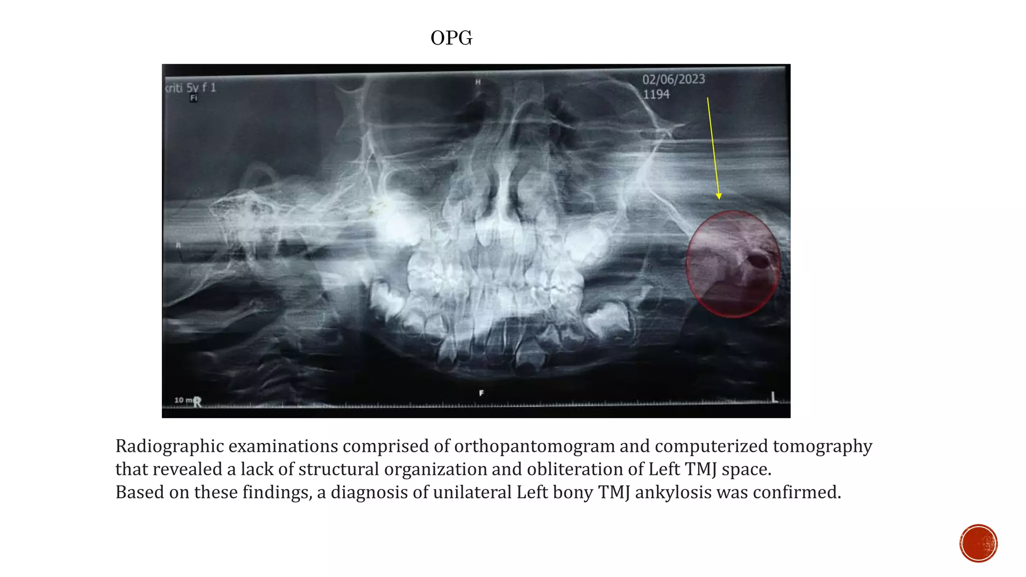 CLINICAL CASE PRESENTATION TMJ ANKYLOSIS.pptx