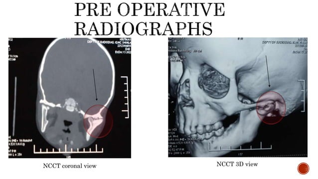 CLINICAL CASE PRESENTATION TMJ ANKYLOSIS.pptx | Dental Health ...