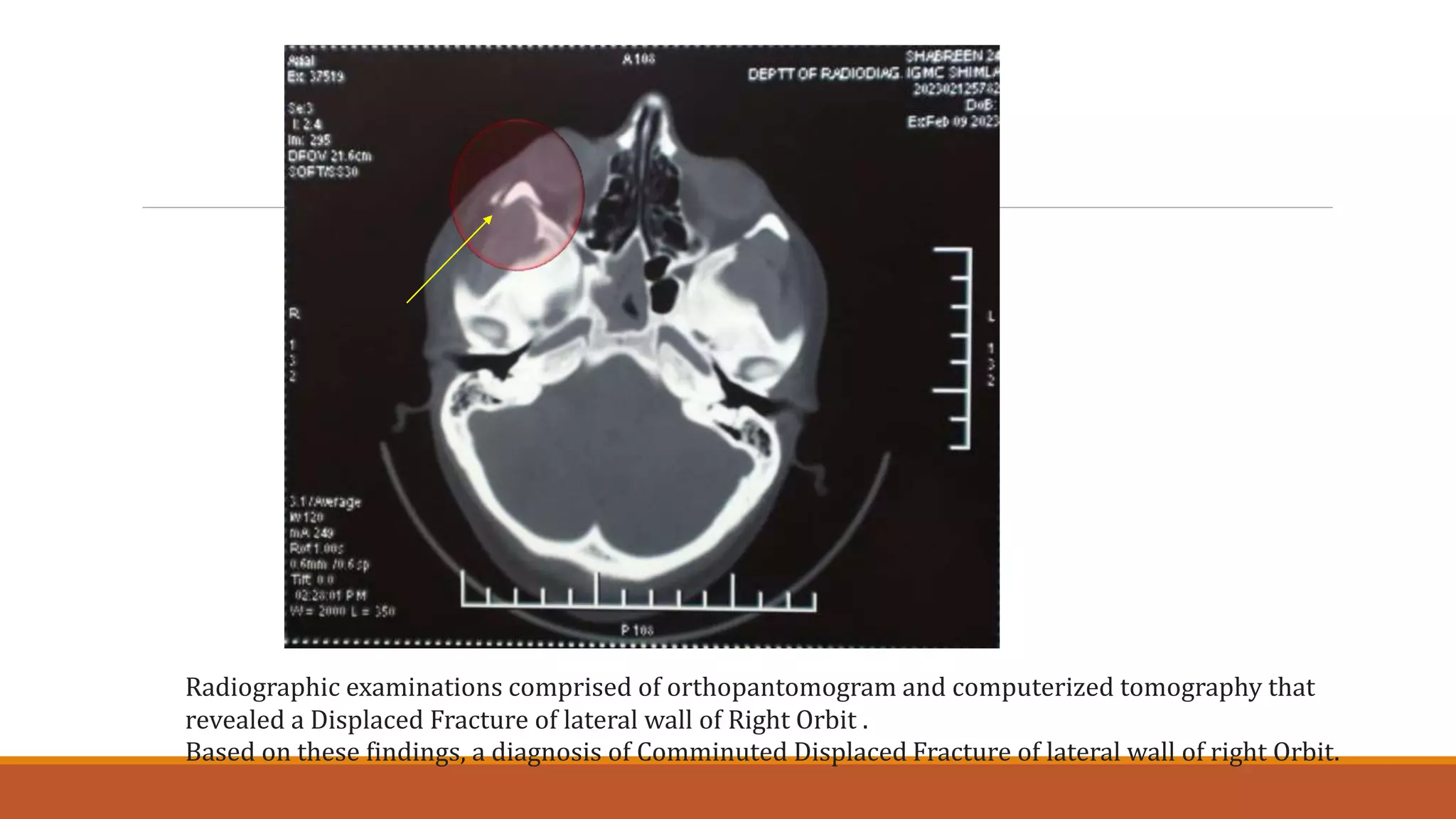 CLINICAL CASE PRESENTATION lateral wall orbit.pptx