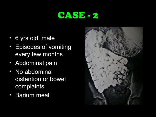 Clinical case asr laparoscopic ladd's procedure for malrotation ...