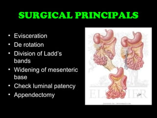 Clinical case asr laparoscopic ladd's procedure for malrotation ...