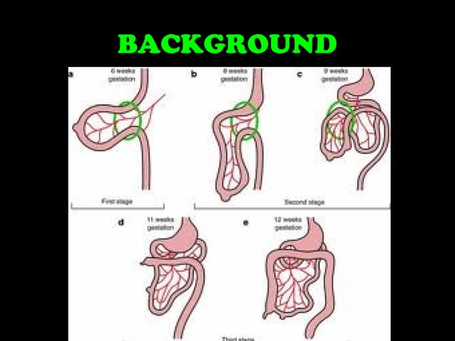 Clinical case asr laparoscopic ladd's procedure for malrotation correction