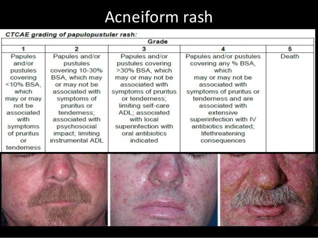 Clinical case base of tongue cancer