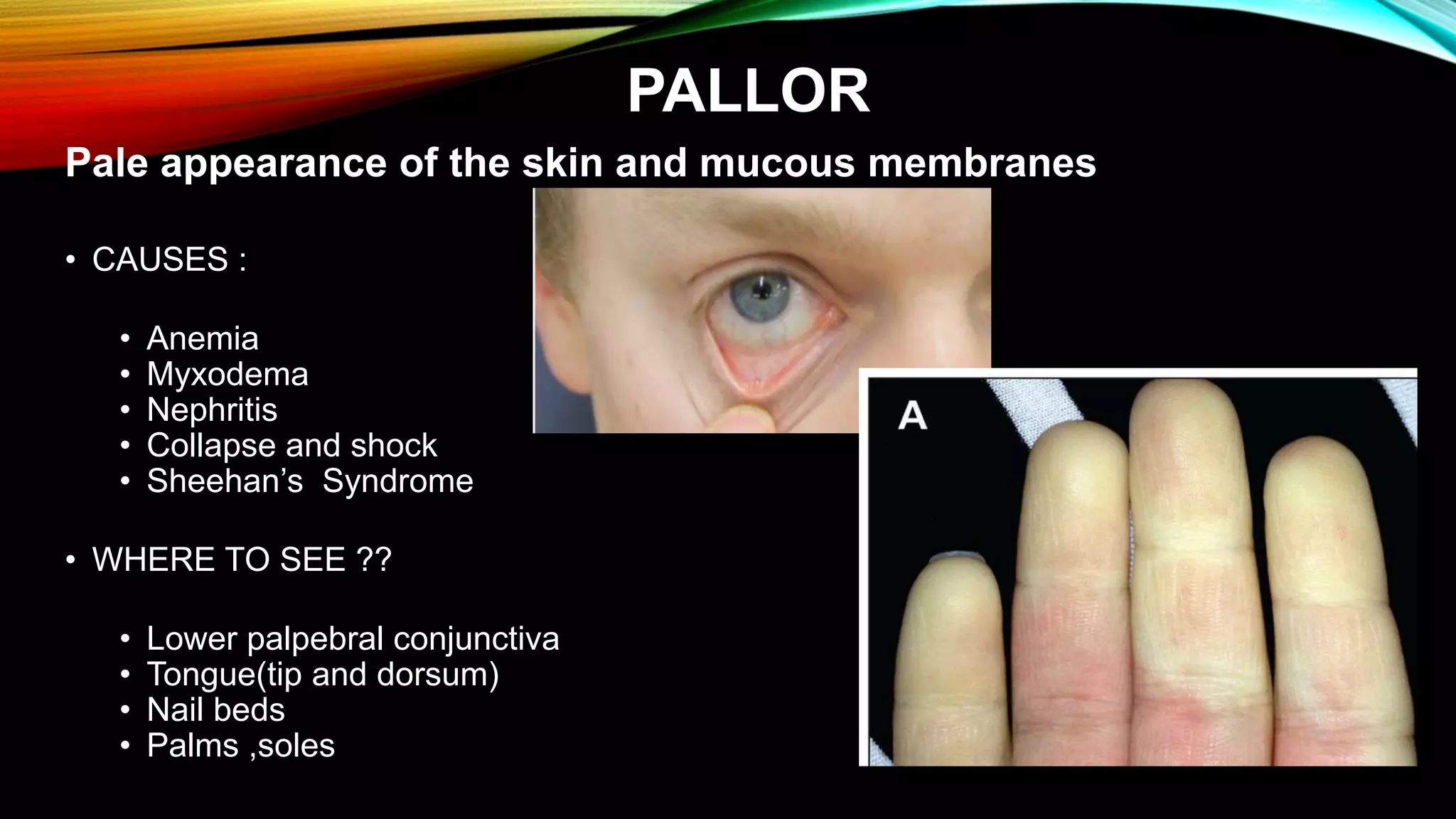 megaloblastic anemia | PPTX | Blood Disorders | Diseases and Conditions