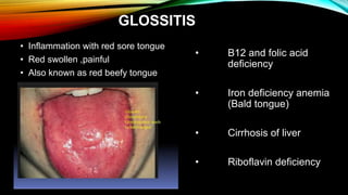 Megaloblastic Anemia Tongue
