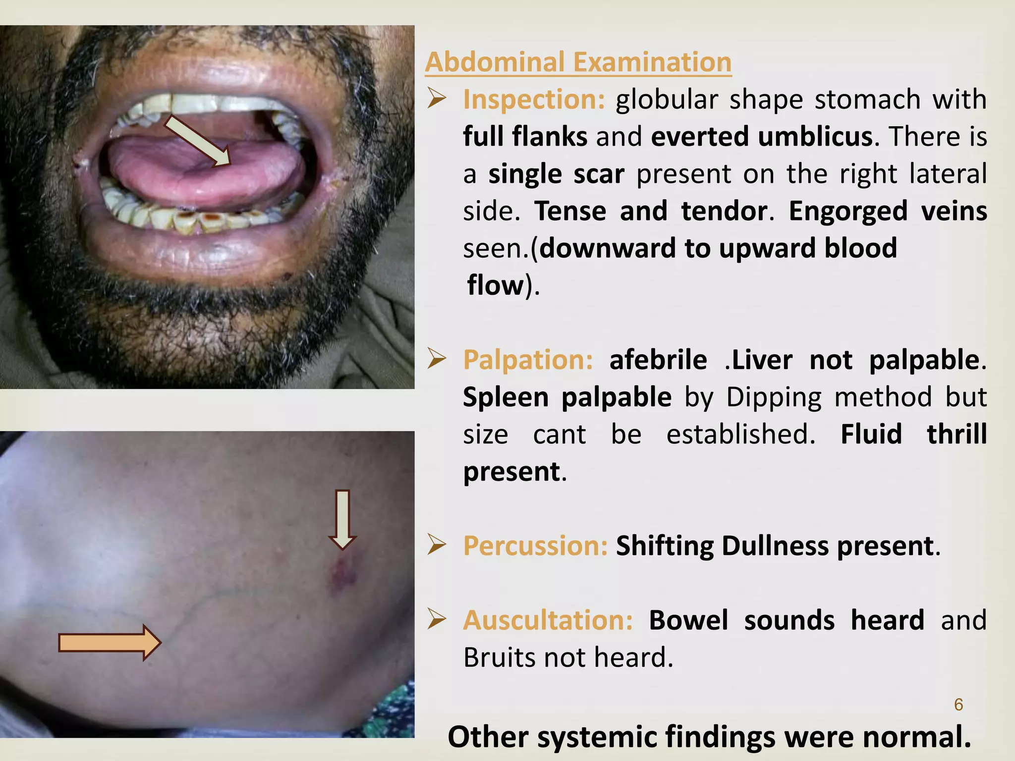 Alcoholic Liver Disease | PPTX
