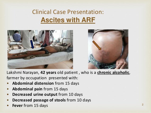 Alcoholic Liver Disease