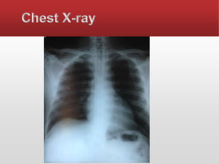 CLINICAL CASE PRESENTATION - STEMI.pptx
